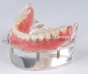China dental 4 impants hybrid denture combination lower arch model supplier