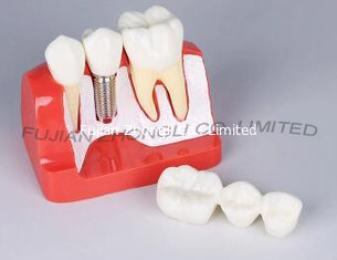 China Dental Implants 3 Units Bridge 2 Crowns Reconstruction supplier
