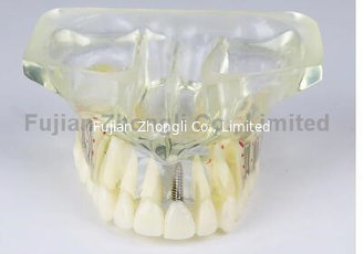 China transparent sinus lift  implant model  Dental Model of osteoporosis dental materials supplier