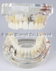 China Transparent prothetic with implant model dental nerve demonstrate model doctor-patient communication model supplier