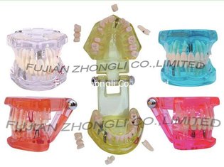 China Dental Upper &amp; Lower Jaws Advanced Work Restoration Combination 3 Implant 2 Bridges 7 Crowns Veneer In Lay Kit of 9 Part supplier