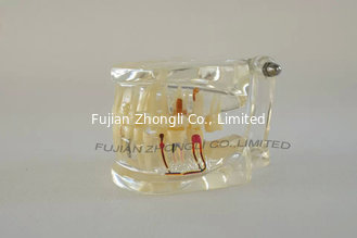 China Dental half Multiple Pathologies Disease Implant Model and half Healthy Model supplier