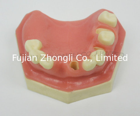 sinus lift dental implant zhongli company supplier