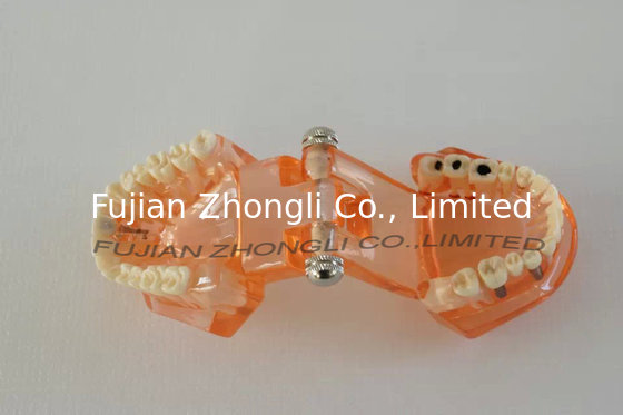 Dentist Dental Implant Disease Teeth Model with Restoration &amp; Bridge Tooth Study supplier