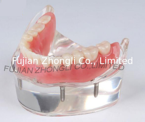 dental 4 impants hybrid denture combination lower arch model supplier