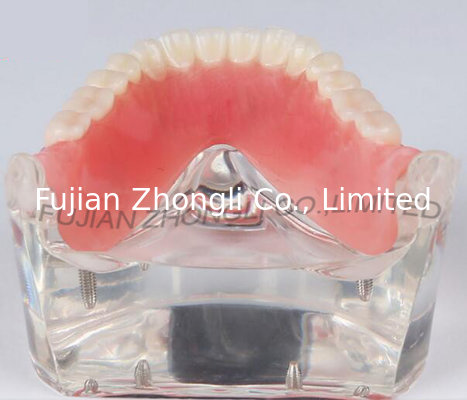 dental 4 impants hybrid denture combination lower arch model supplier