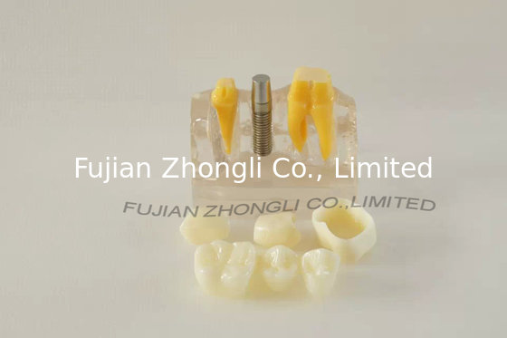 Dental Implant 3 Unit Bridge 3 Crowns Set of 6 Parts Model 4 Times Life-Size Reconstruction supplier