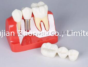 Dental Implants 3 Units Bridge 2 Crowns Reconstruction supplier