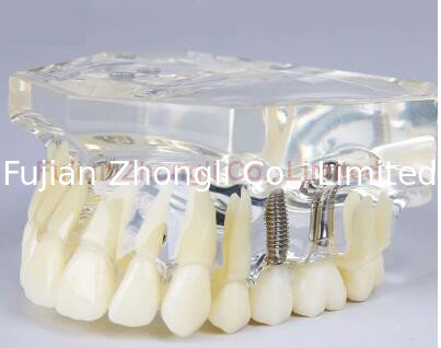 Transparent base station on both sides of the implant nail bridge demonstration supplier