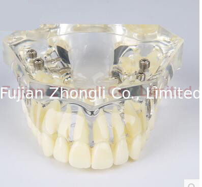 Transparent base station on both sides of the implant nail bridge demonstration supplier
