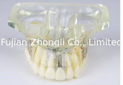transparent sinus lift  implant model  Dental Model of osteoporosis dental materials supplier