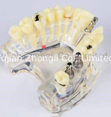 dental caries dental bridge dental teaching communication oral implant nail demonstration model supplier