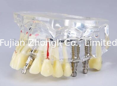 dental caries dental bridge dental teaching communication oral implant nail demonstration model supplier