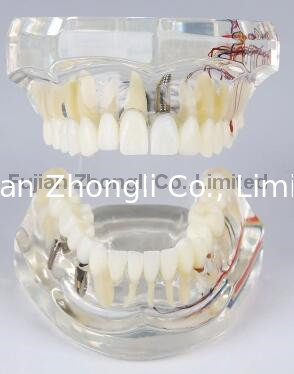 Transparent prothetic with implant model dental nerve demonstrate model doctor-patient communication model supplier