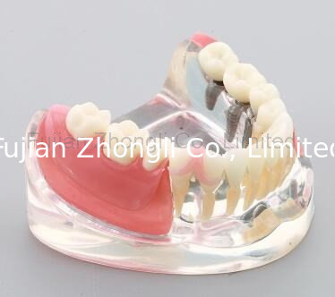 Dental 3 Implant 2 Unit Bridge of 3 Parts supplier