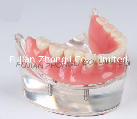 Dental 4 Implants Locator Lower Arch Model supplier