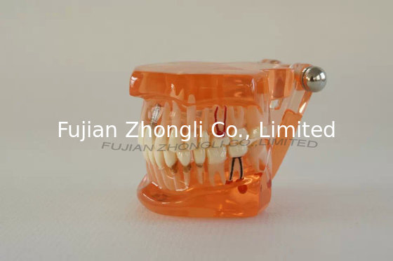 Dental Upper &amp; Lower Jaws Advanced Work Restoration Combination 3 Implant 2 Bridges 7 Crowns Veneer In Lay Kit of 9 Part supplier