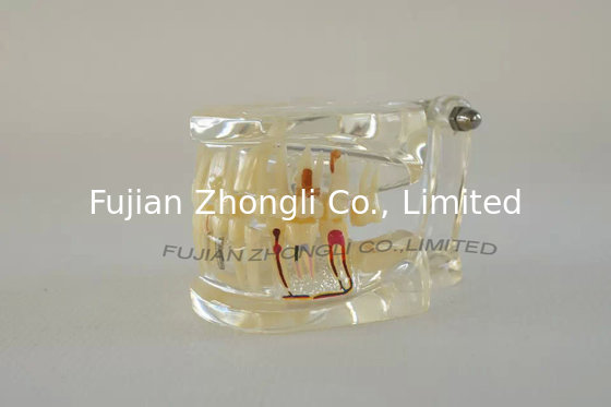 Dental half Multiple Pathologies Disease Implant Model and half Healthy Model supplier