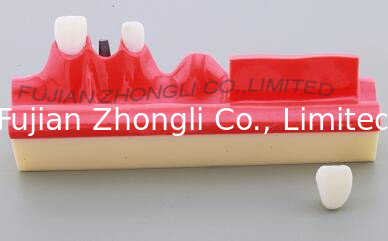 Dental implanting step demonstration red strip planting demonstration model implanting nail display crown configuration supplier