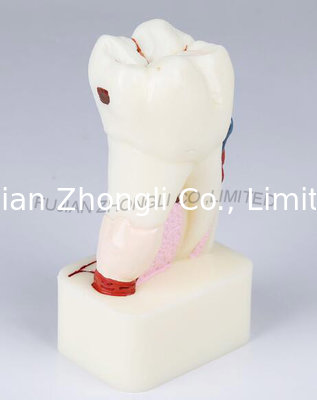 4 times dental disease comprehensive disease model dental caries dental calculus pulp stone occlusal wear pathological supplier
