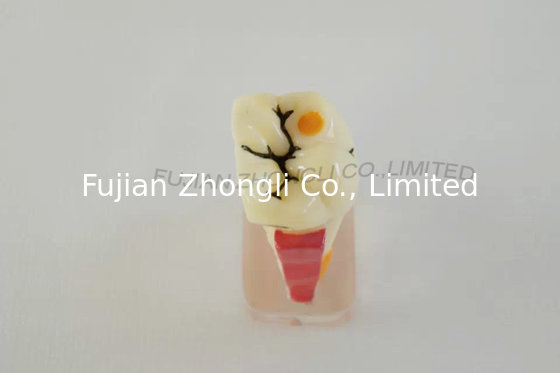 dental 4 times periodontal disease model with nerve model supplier