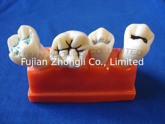 Dental Four times the pit and fissure model supplier