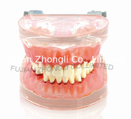 Dental Transparent gingivitis model pathology oral model dental calculus with metal jaw frame new supplier