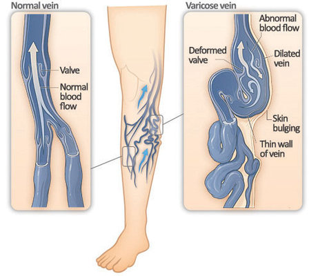 Spider Veins removal Machine portable laser for vascular