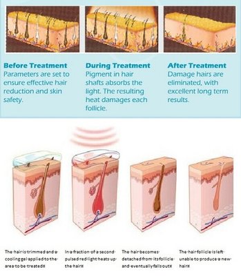 ipl hair removal machine high quality ipl laser hair removal machine