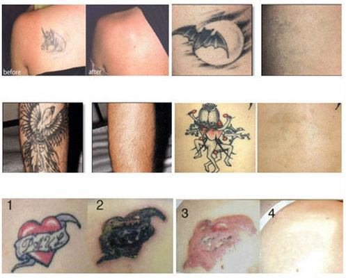 Tattoo Removal Beauty Equipment Q-Switch Nd yag Laser machine laser tattoo removal machine