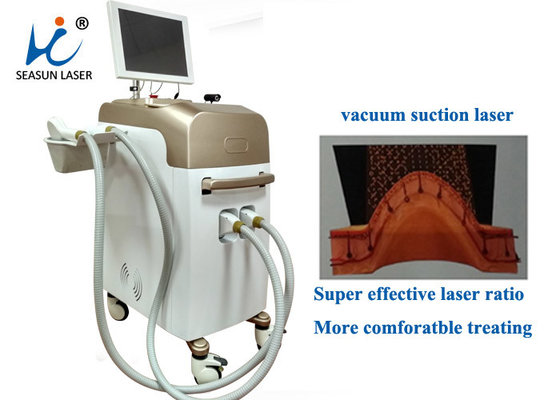 Vacuum Laser Therapy Lightsheer Duet Diode Hair Removal Permanent For Face