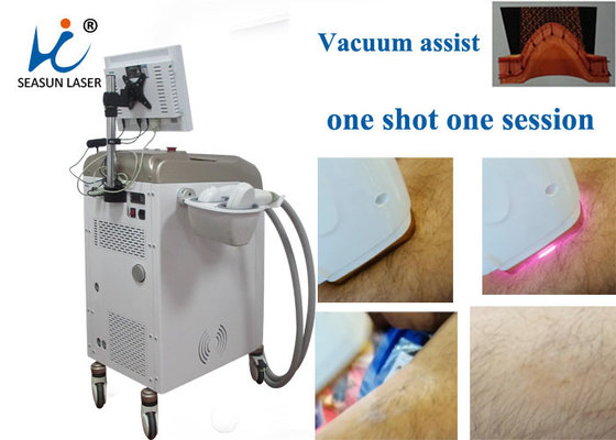 Fast Vacuum Laser Hair Removal Machine Comfortable Permanent Hair Reduction