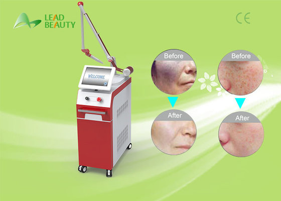 professional factory price q-switched nd yag tattoo laser removal machine