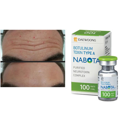Bocouture Meditoxin Botulinumtoxin 100u for Anti Wrinkles Botulax 200units Nabota