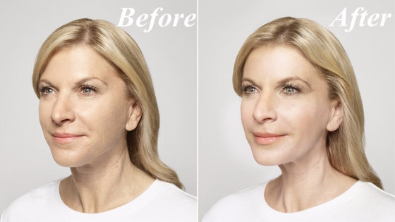 Meso 1ml/2ml/3ml Cross Linked Hyaluronic Acid Dermal Filler For face