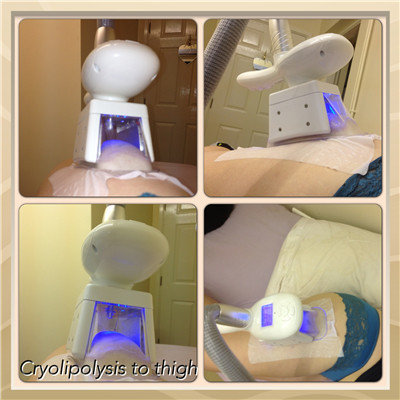 CE approved lipocryo fat freezing device cryolipolysis 10-inch LCD touch screen , super frozen wave control technology