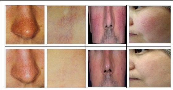 Latest Hot Selling Spider Vein Removal Machine/ vascular
