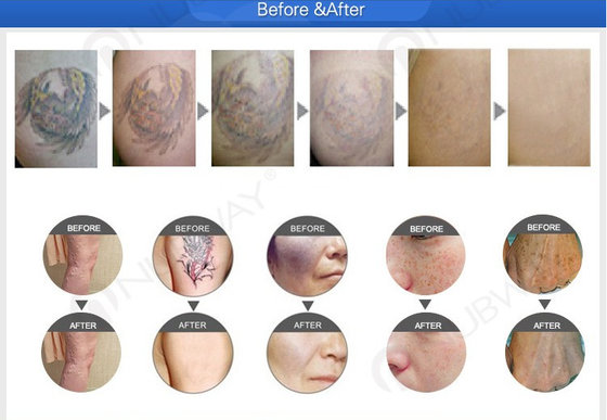 Newest !!! high quality q switched nd yag laser tattoo removal machine / Professional Nd Yag Laser Scar Removal Equipmen