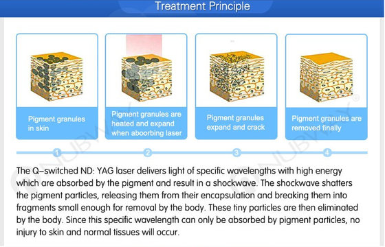 factory price professional tattoo & pigment removal / EO q-switched nd: yag laser