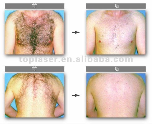 Professional Permanent Diode Laser Hair Removal System 8mm Spot Size Powerful Cooling System