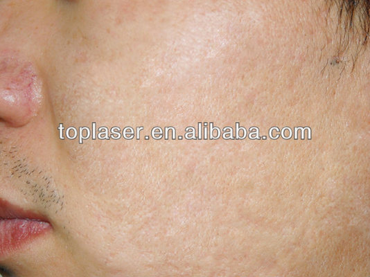 Co2 Fractional Laser Skin Tightening Machine / Anti Aging Machines Skin Care