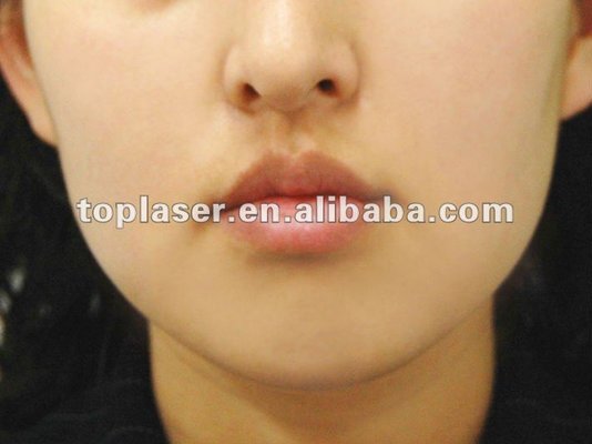 Erbium Glass Fractional Laser, 1550nm Fractional/Aging Spots/Wrinkles Removal
