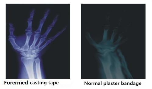 Forermed High Polymer Orthopedic Casting Tape and Splint