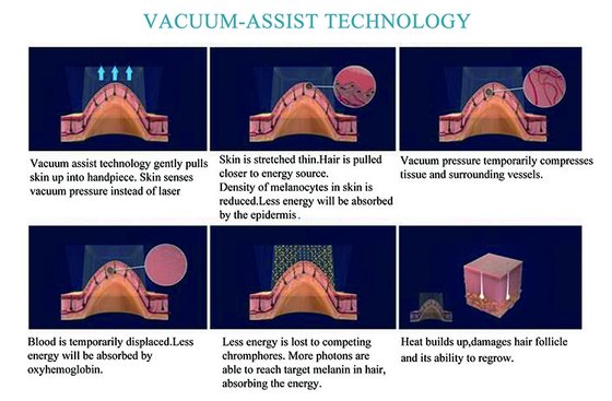 Vacuum Therapy Hand Hair Removal Machine , Salon Laser Hair Removal System