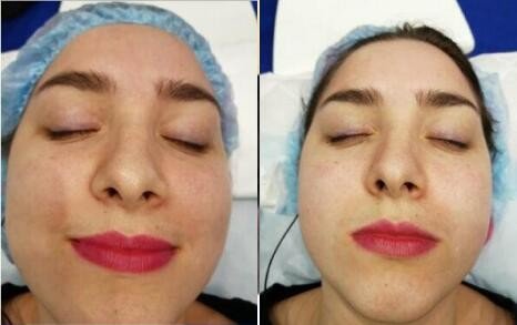 Professional Diamond Microdermabrasion Machine , Spa / Clinic Diamond Peel Machine